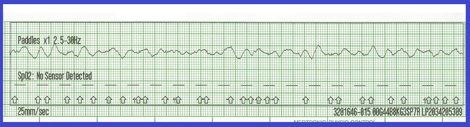 Code Blue: Sudden Cardiac Arrest