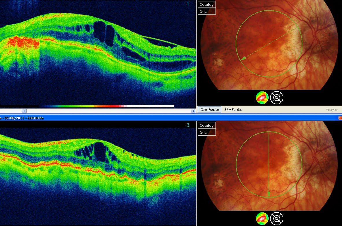 Tomografia ClaraVision: OCT Mácula