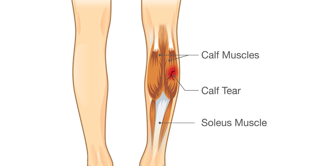 Calf Pain: Plantaris Tendon Rupture
