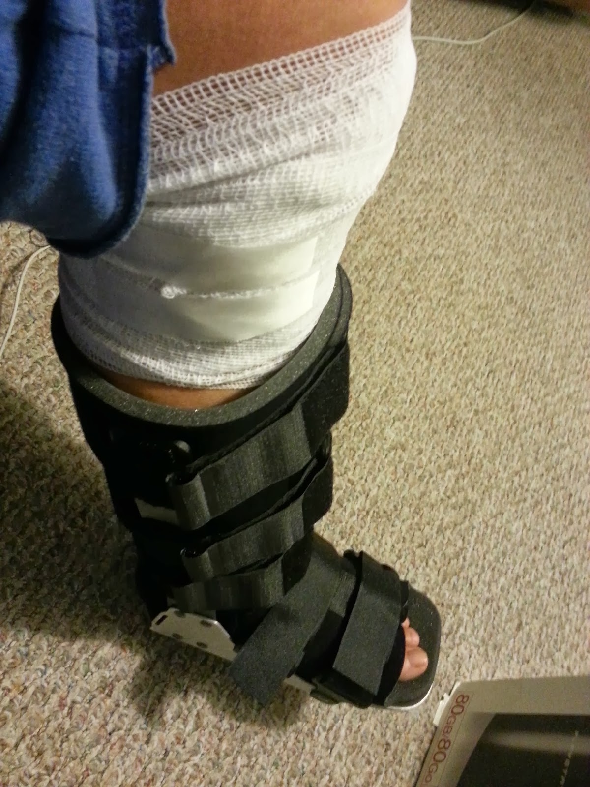 Kat's Broken Leg Adventures: Week 2 - Off With The Cast On With The Boot!