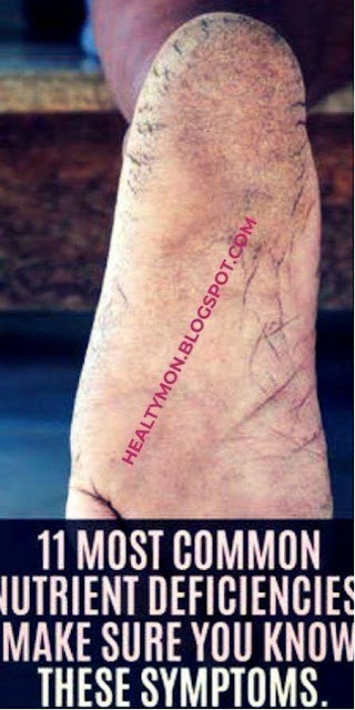 OKHOMOL: 11 Most Common Nutrient Deficiencies. Make Sure You Know These ...