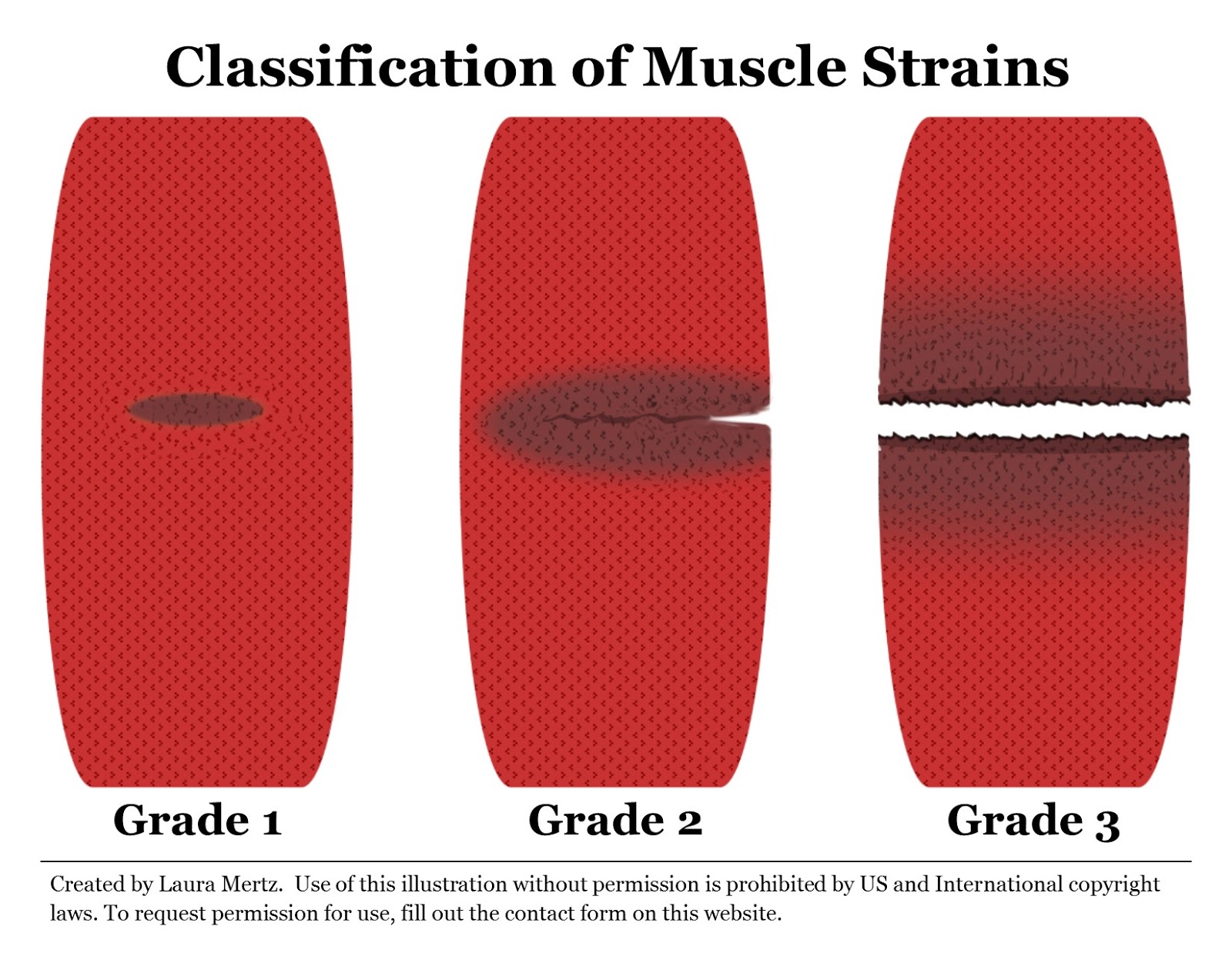 Performing Arts Medicine: Is it a Sprain or a Strain? (part 2)
