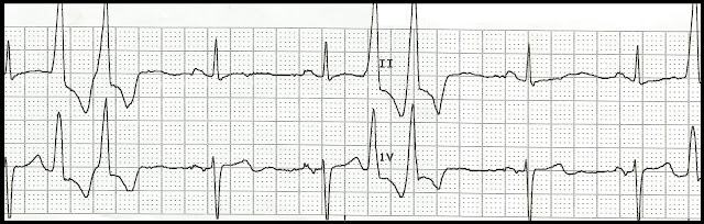 EKG Rhythm Strip Quiz 110