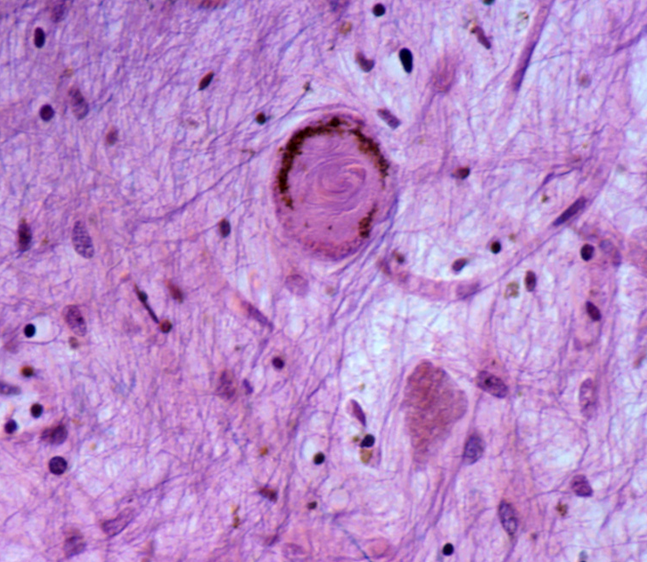 NeuroAnatomía Dr. William Ganem: Parálisis supranuclear progresiva ...