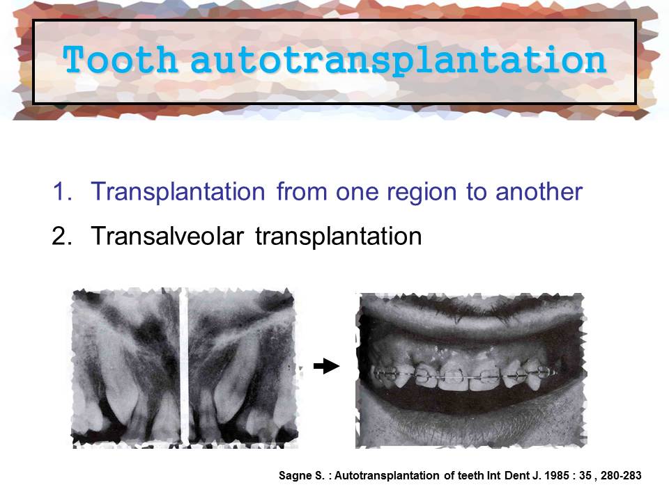 Dentistry: Tooth Transplantation