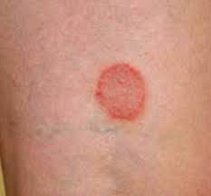 Skin Ulcers : Signs and Symptoms, Cause and Treatment - ᴍʏʜᴇᴀʟᴛʜᴀᴅ