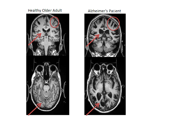 Alzheimer's 101: Taking pictures of your brain - MRIs and Alzheimer's ...