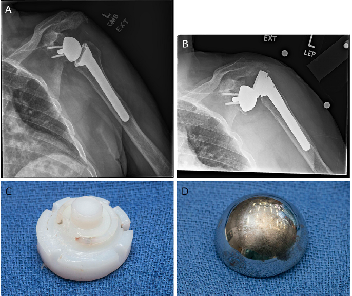 UW Shoulder and Elbow Academy: Reverse total shoulder failure from ...