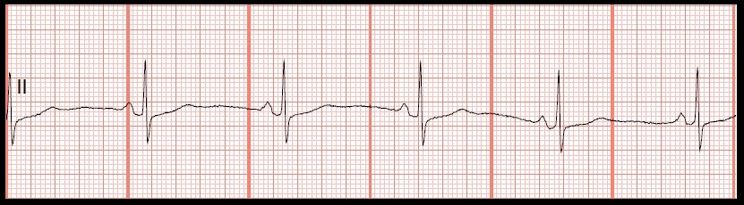 Practice EKG Rhythm Strips 158