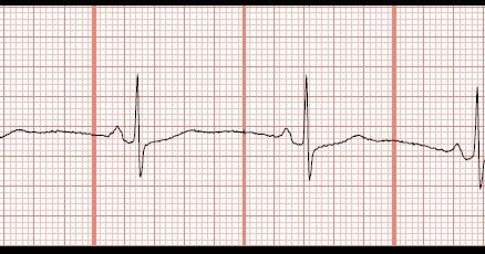 Float Nurse: Practice EKG Rhythm Strips 158
