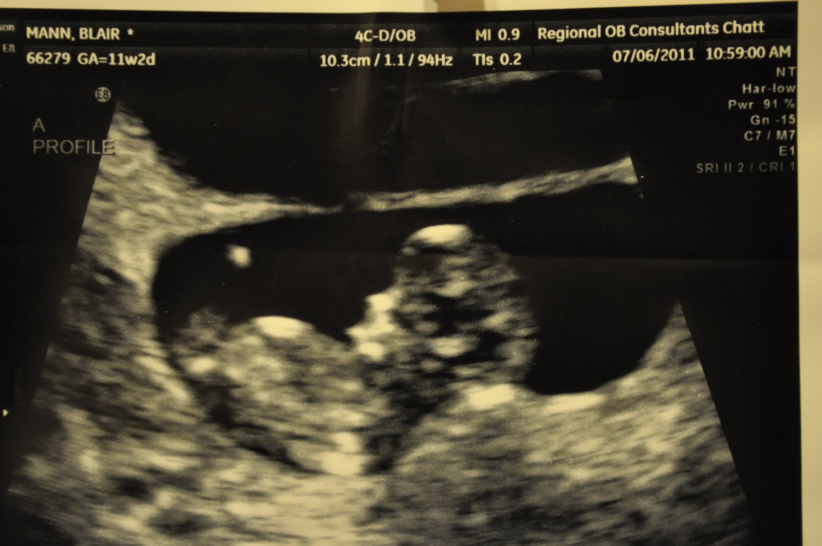 Little Mann Girls!!: Ultrasound - 11 Weeks