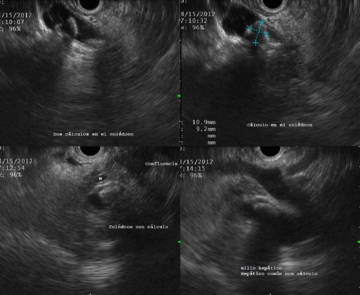 ENDOSCOPIA TERAPEUTICA Día a Día: Coledocolitiasis USE - CPRE