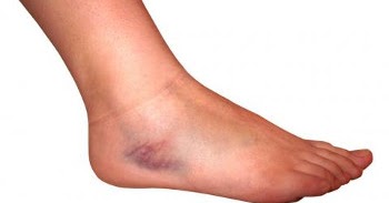 Dislocación de tobillo - Botiquin de primeros auxilios PRO!!