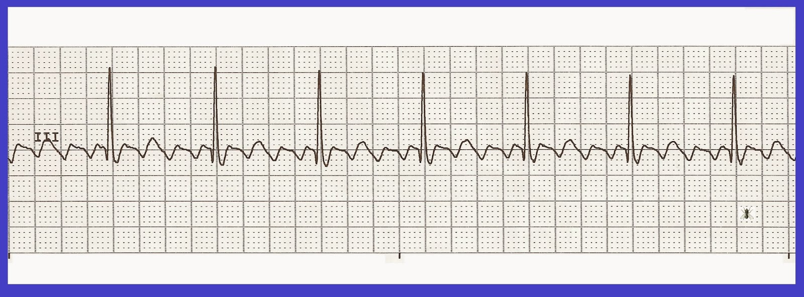 EKG Rhythm Strip Quiz 192