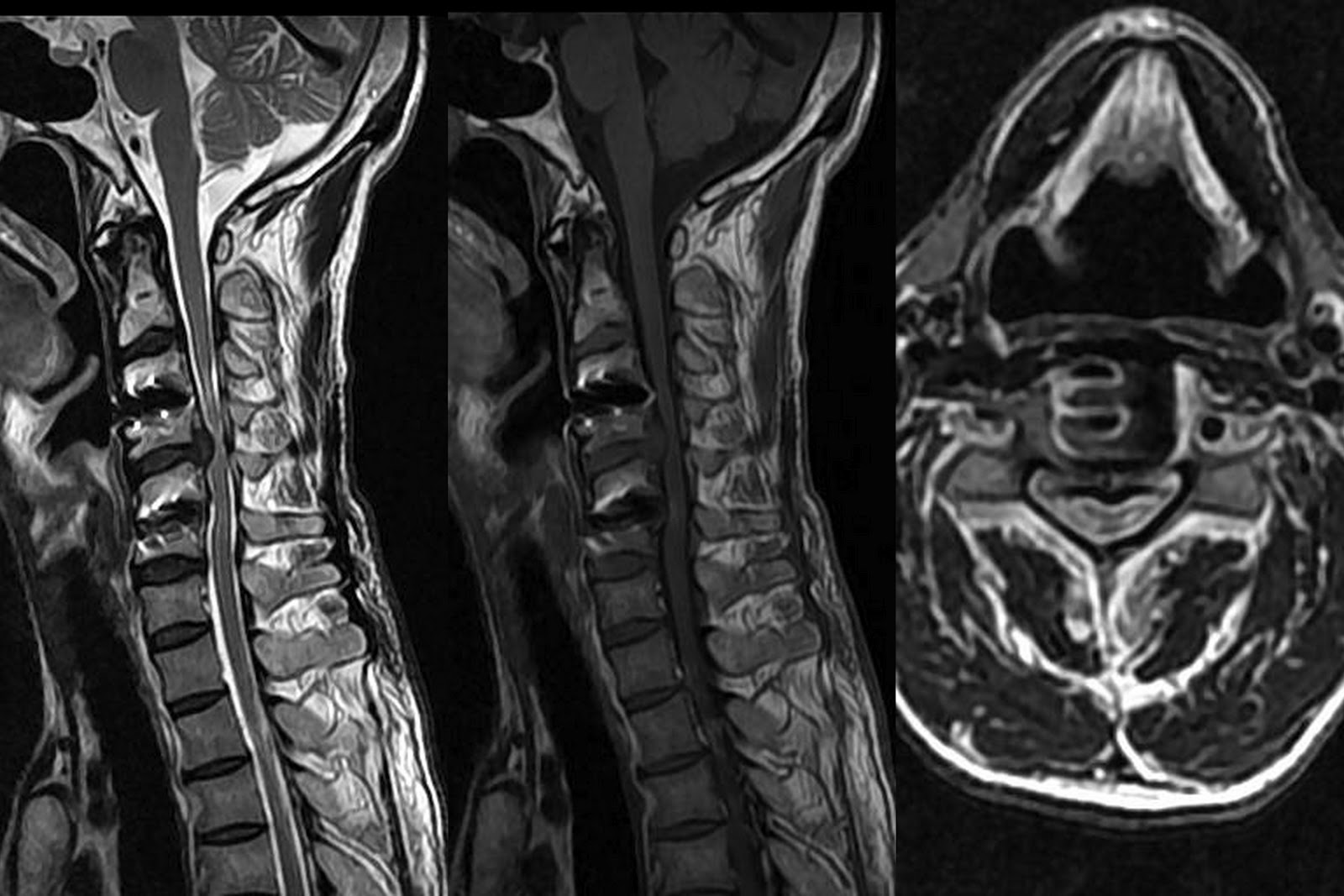 Dr Balaji Anvekar FRCR: Discectomy and Fusion Cage MRI