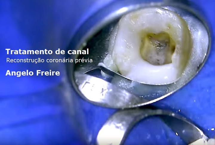 ENDODONTIA: Tratamento de canal: reconstrução coronária prévia - Angelo ...