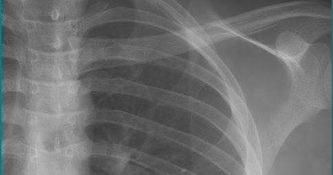 Fractured Rib - Fracture Treatment