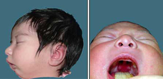 SÍNDROME DE PIERRE ROBIN | Motricidade Orofacial