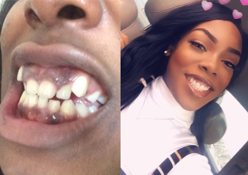 Photos: US-based Nigerian lady with deformed teeth shows off the ...