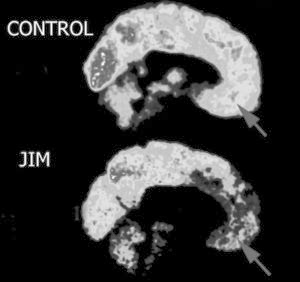 El neurólogo que descubrió por accidente que era un psicópata