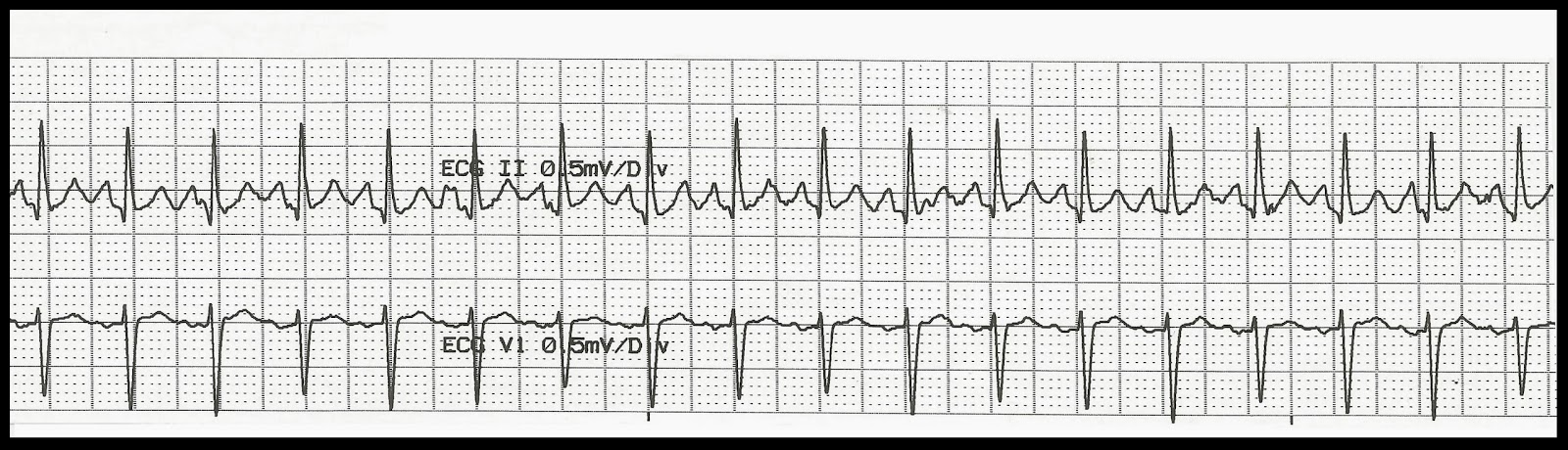 EKG Rhythm Strip Quiz 203