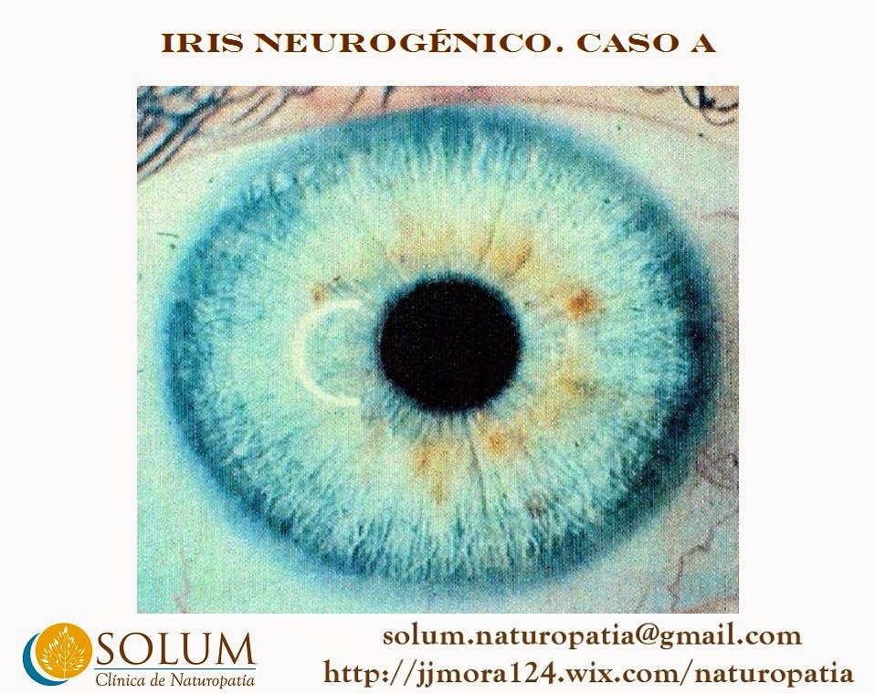 Enfermedades vistas a través del Iris.