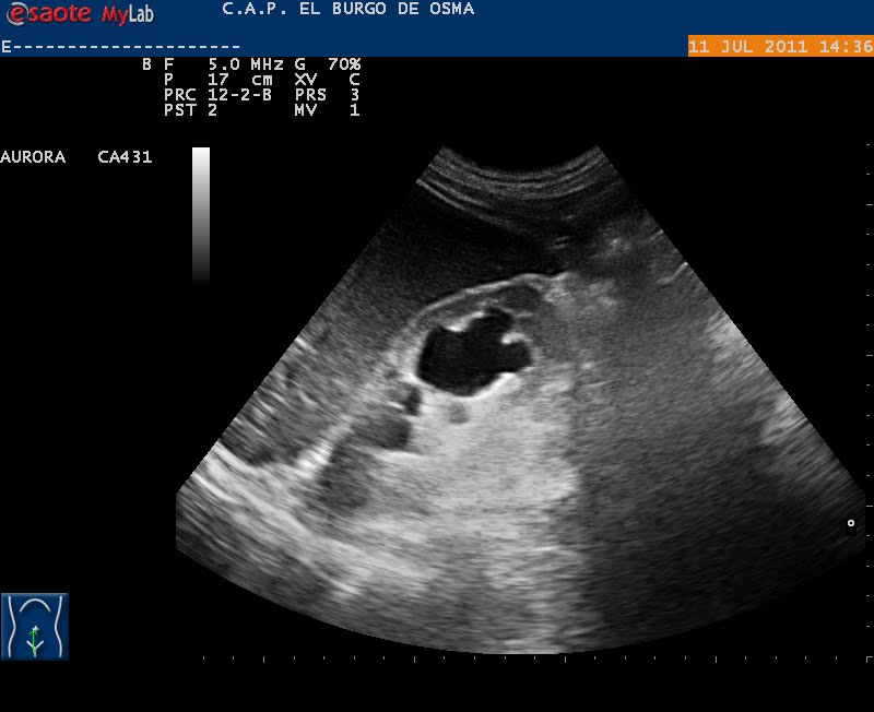 EcoCyl-Grupo: Hidronefrosis bilateral