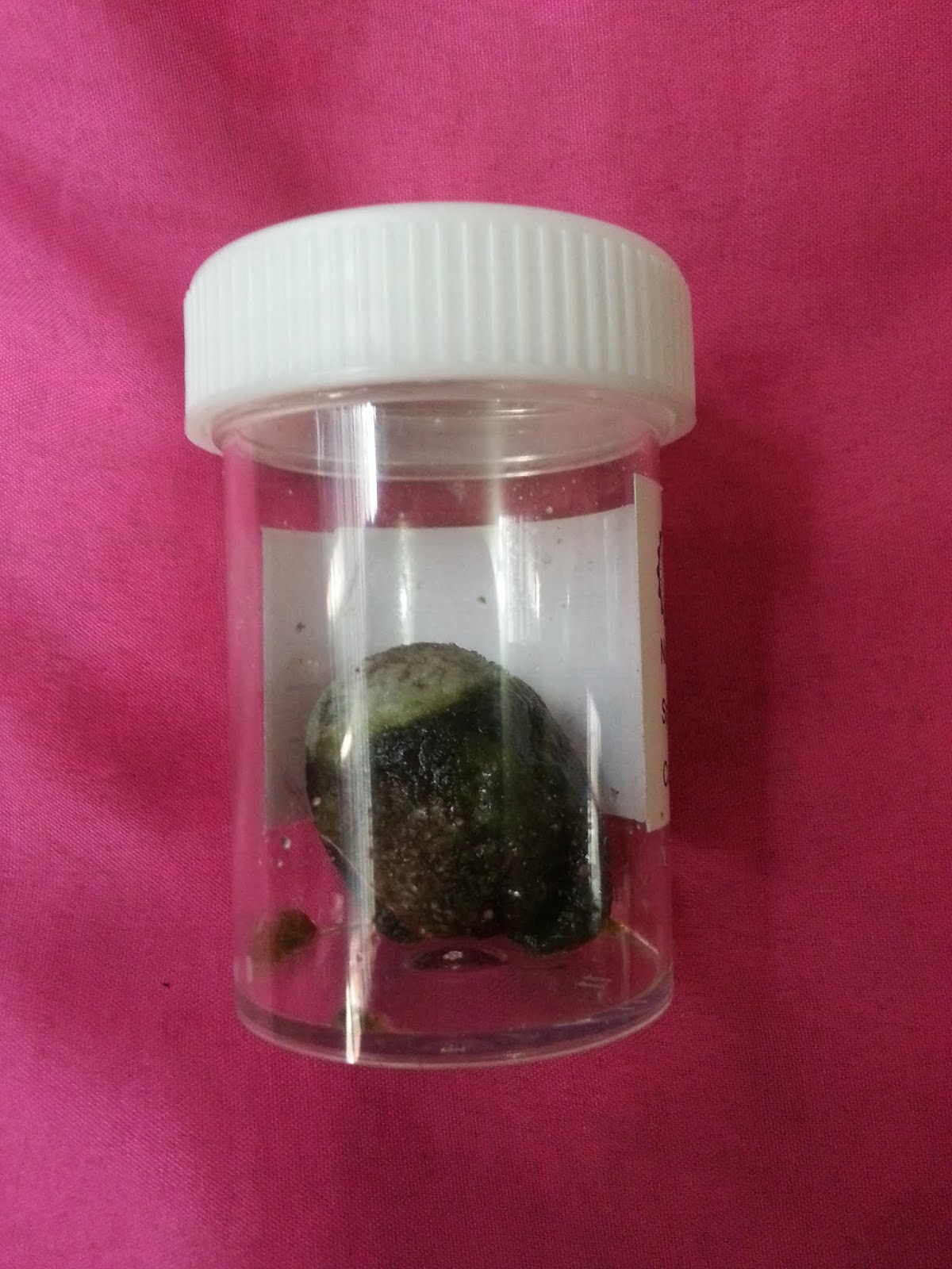 laparoscopic cholecystectomy (Gallstone Removal): laparoscopic ...