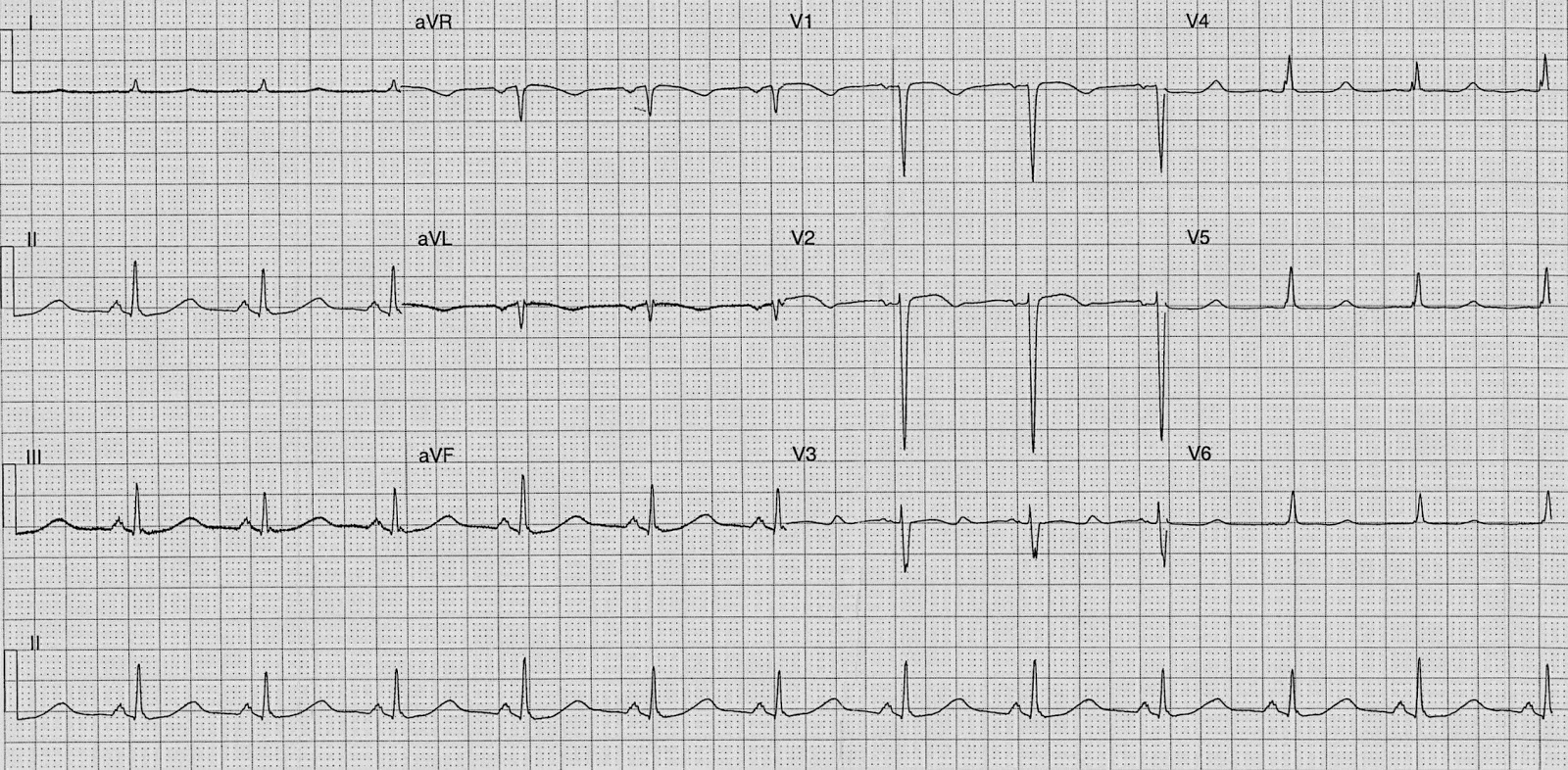 ECG of the Week: ECG of the Week - 21st April 2014 - Interpretation