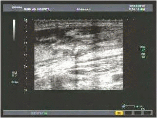 VIETNAMESE MEDIC ULTRASOUND: CASE 313: FISH BONE APPEARING in NECK, Dr ...