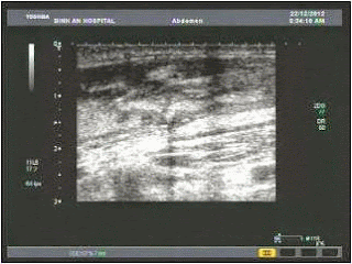 VIETNAMESE MEDIC ULTRASOUND: CASE 313: FISH BONE APPEARING in NECK, Dr ...