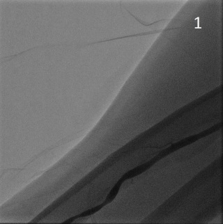 PROF DR HAKAN ÖZHAN: 1.BÖLÜM: KORONERE ERİŞİM