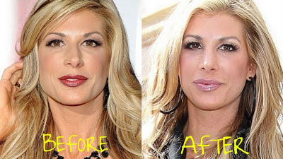 Alexis Bellino Plastic Surgery Before and After Botox Injections and ...