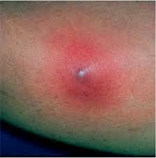 cara cepat mengobati bisul ~ Cara Mengobati Penyakit Maag Kronis