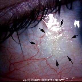 Images For Conjunctival Xerosis (Dry Eye) And Bitot's Spot ~ YOUNG ...
