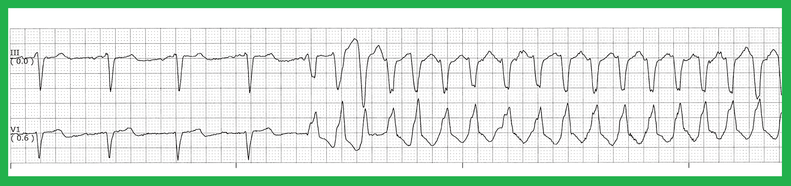 Various Ventricular Tachycardias