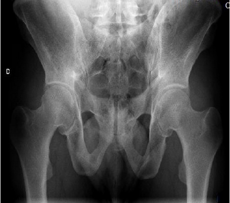 Tecnicos Radiologos: Fractura de Pelvis y de Cadera (todas las ...