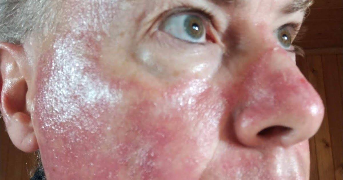 So let's see how this goes...Efudex/Efudix