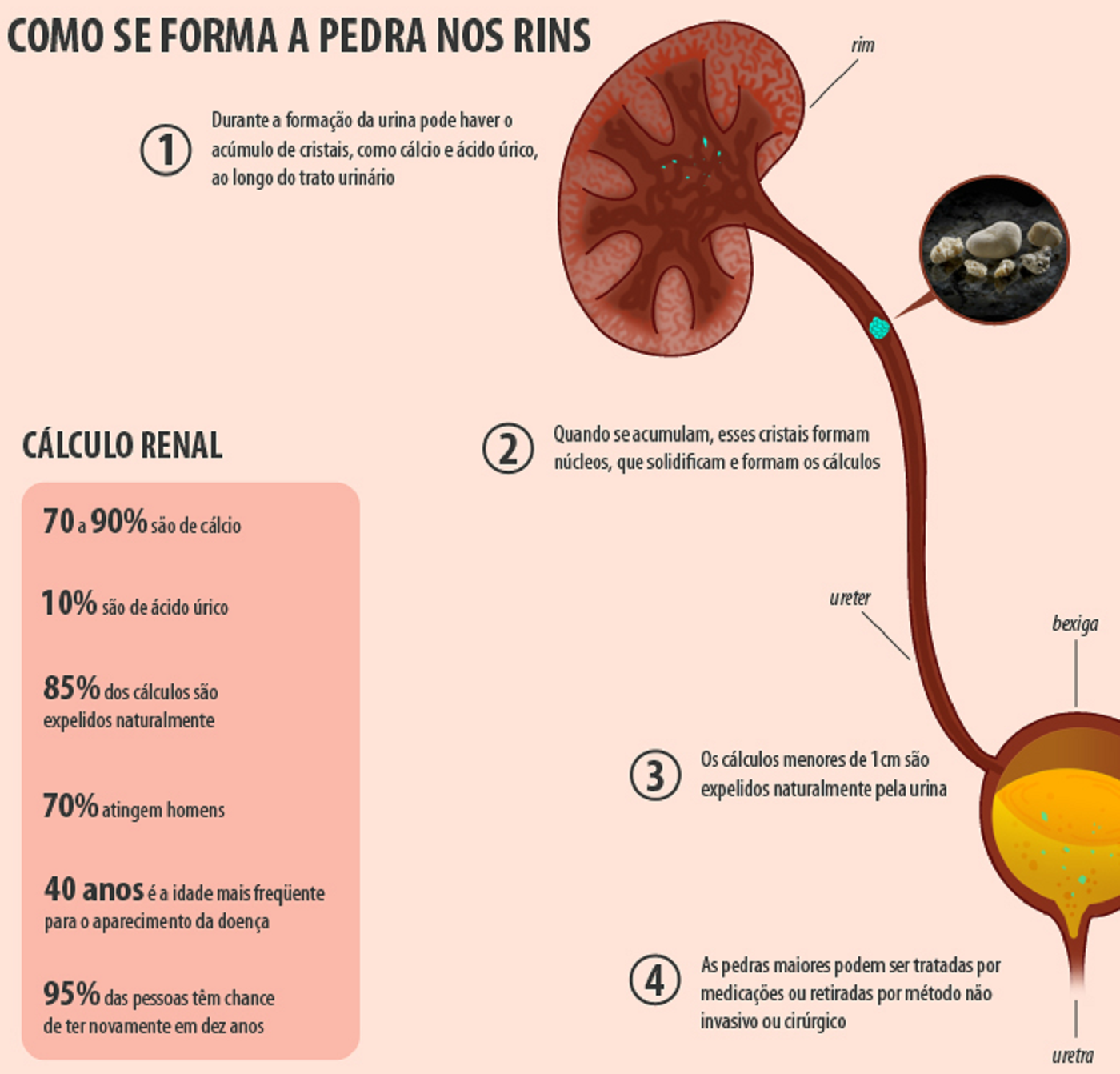 SAÚDE: Fique por dentro sobre Cálculo Renal - Pedra nos Rins