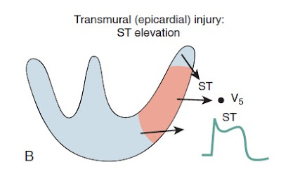 Subendocardial vs Transmural Myocardial Ischemia.