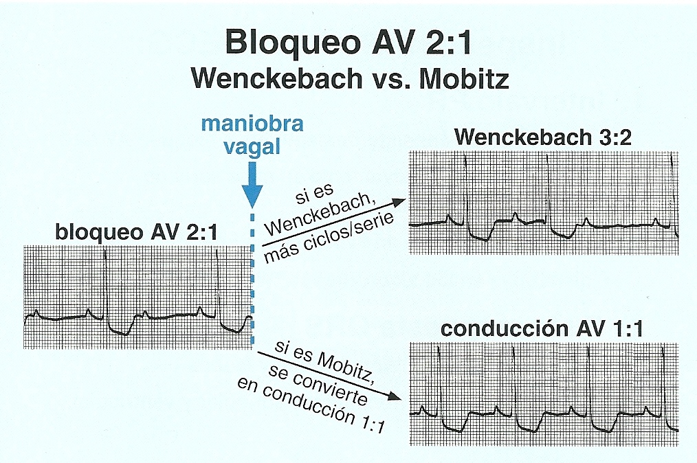 Electrocardiograma: Bloqueos Aurículo ventriculares