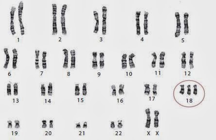 Macam-macam Sindrom yang disebabkan oleh Mutasi Kromosom | Biologi ...