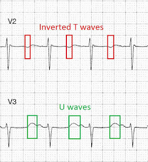 ECG of the Week: ECG of the Week - 14th March 2016 - Interpretation