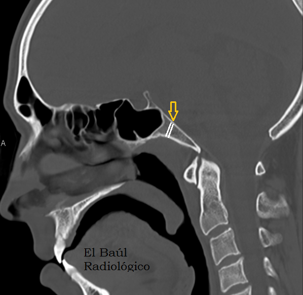 El Baúl Radiológico: SINCONDROSIS ESFENOBASILAR. (Sphenobasilar ...