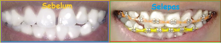 Mr Braces 7Eleven: Appt Tukar Getah Braces - Green String (Power Chain)