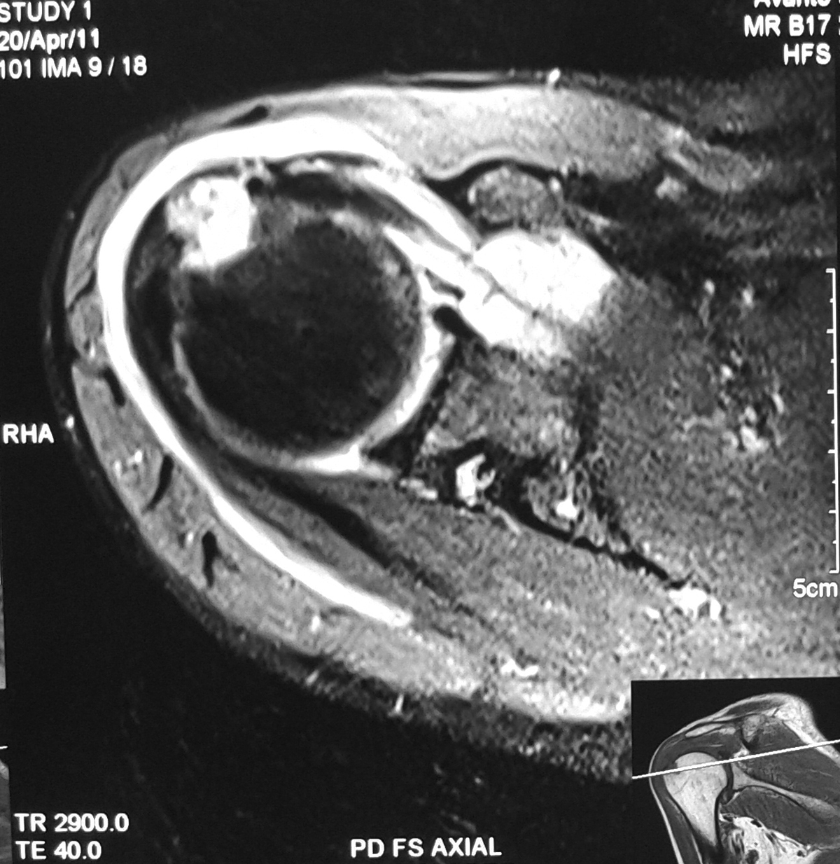 Supraspinatus Tendonitis Mri
