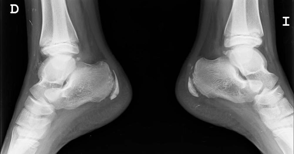 Reumails. Reumatología al día: El dolor del talón en niños: La ...