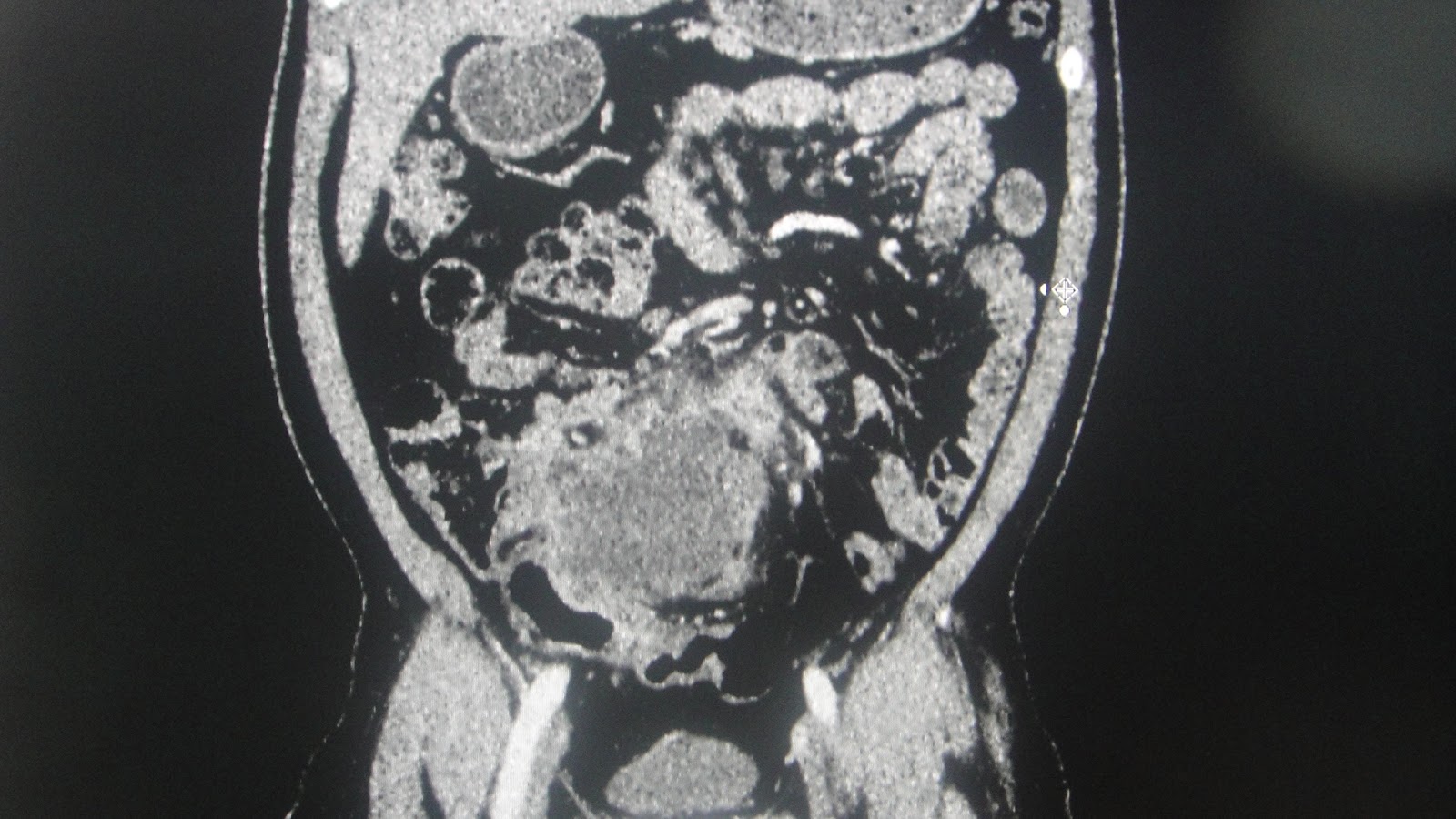 VIETNAMESE MEDIC ULTRASOUND: CASE 150: PERIUMBILICAL MASS, Dr PHAN ...