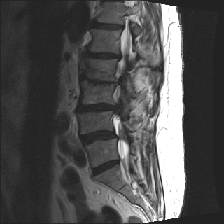 Skull and Spine: Modic Type 1 change and low back pain