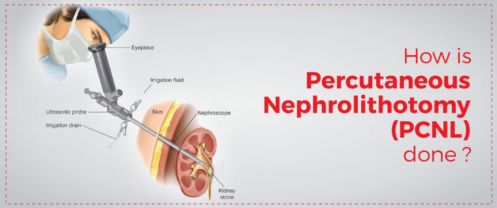 Laser surgery for kidney stone: Percutaneous Nephrolithotomy for Kidney ...